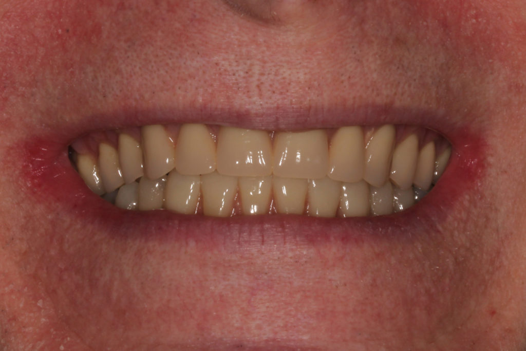 TeethXpress Full Arch Dental Implants - Shawnee, OK