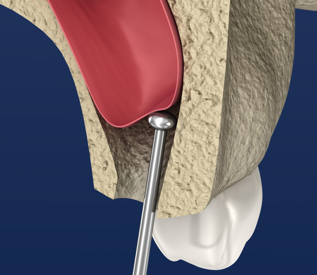 Bone Grafting - Shawnee, OK - Hopkins Dental Clinic